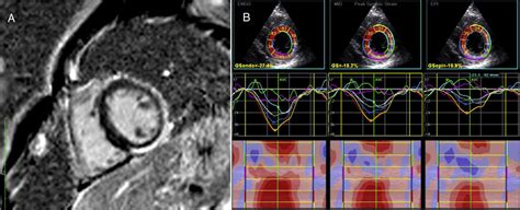 A Phase Sensitive Inversion Recovery Sequence Left Ventricular Short