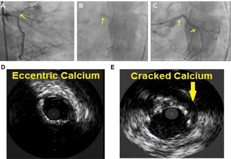 A Case Of LM To LCX With Eccentric Calcium Treated With IVL Download Scientific Diagram