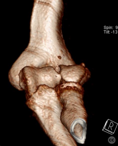 Dubberly 34 Shear Plus Comminuted Trans Condylar Trochlear Fracture