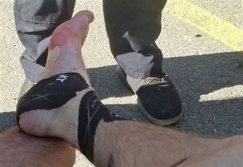 Blister On My Foot From Running On Sale