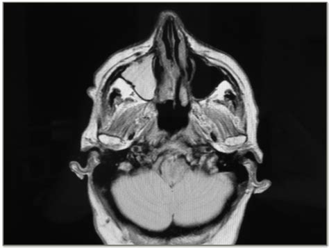 Sinusite Odontogena Sintomatica Trattamento Nella Fess Maurizio G Vigili