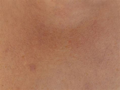 Understanding Rosacea Causes Symptoms And Treatment Options We
