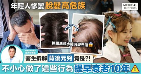 未到30歲被笑高髮線似「清朝人」？皮膚科醫生拆解5大日常脫髮陷阱 附救髮小貼士 Medical Inspire 醫．思維 Line Today