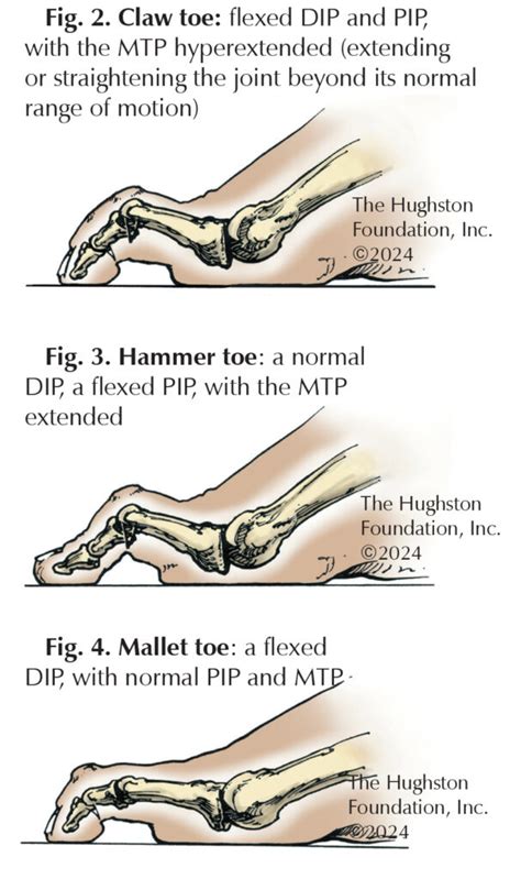 Lesser Toe Deformities Understanding Claw Toe Hammer Toe And Mallet Toe Hughston Clinic