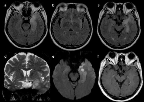 Herpes Simplex Encephalitis A C Axial Flair Images Show Download Scientific Diagram