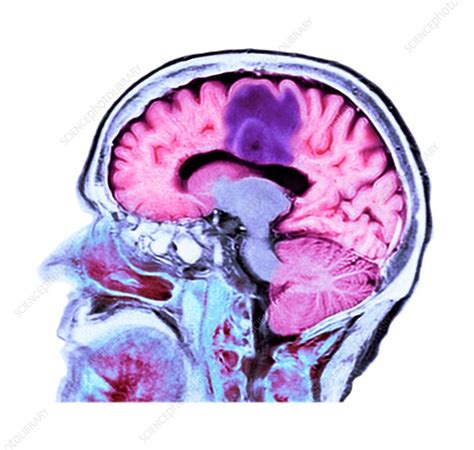 Glioblastoma Brain Cancer Ct Scan Stock Image F0238539 Science
