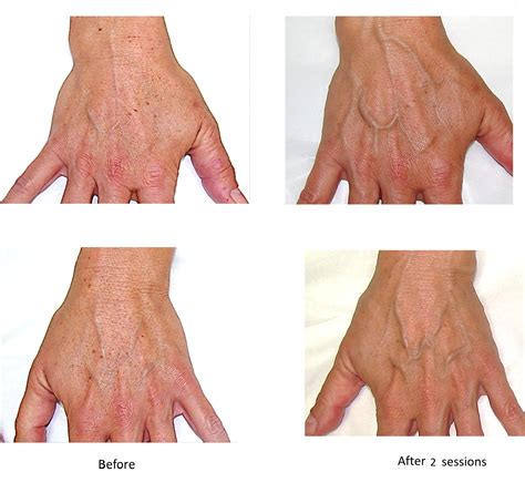 Hands Rejuvenation COL Center