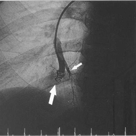 After Successful Coil Embolization No More Flow Forward Large White