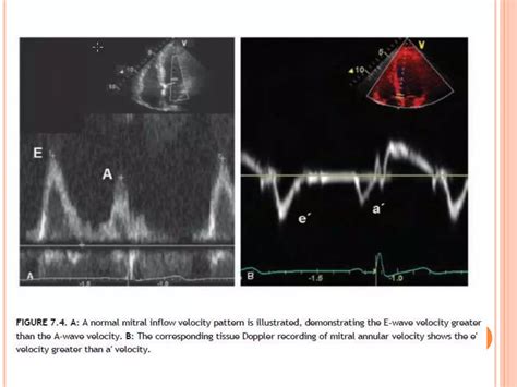 Diastolic Dysfunction 2016 Pptx Heart And Cardiovascular Diseases Diseases And Conditions