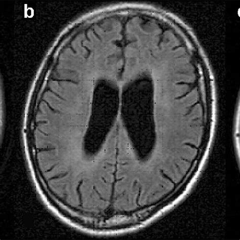 Pdf Mri Imaging Features Of Hiv Related Central Nervous System Diseases Diagnosis By Pattern