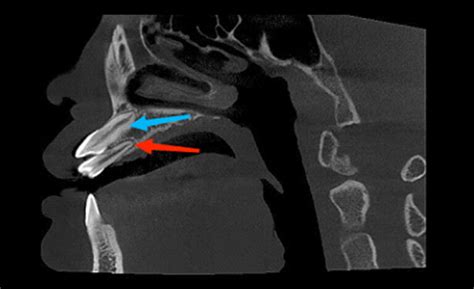 Airway Analysis In Orthodontics How Cbct Supports Better Breathing Sn Imaging
