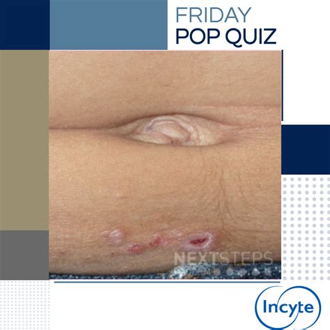 Friday Pop Quiz 9 20 2024 Next Steps In Dermatology