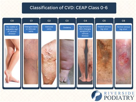 Chronic Venous Insufficiency Cvi Riverside Podiatry
