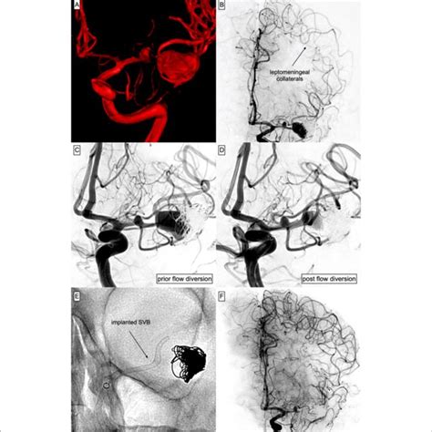 Paraophthalmic Aneurysm Lateral View A A Headway 21 Microcatheter