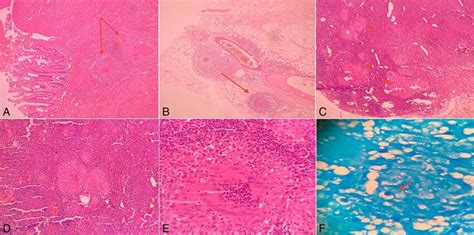 Histopathology Examination A Section Of Intestine Showing Dense