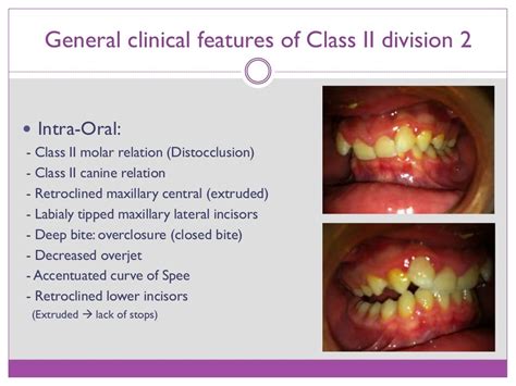 Class Ii Division 2 Malocclusion