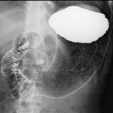 Examples Of Full Gastric X Ray Images A A Sample Of Nongastritis