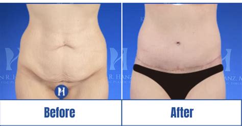 Abdominoplasty Before And After Photos