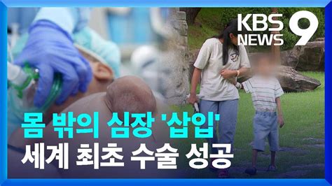 심장이 몸 밖에 달린 어린이세계 최초 수술 성공 9시 뉴스 Kbs 20230817 Youtube