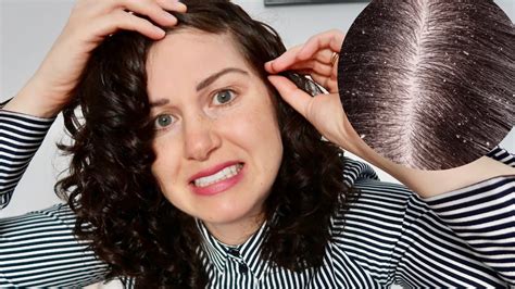 Scalp Buildup Causes Solution Pro Media Mag