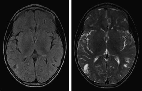 Focal Cortical Defect Axial Flair Tr 2200 Te Min Full And Fov 25