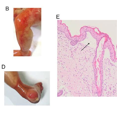 Clinical Photographs And He Staining Results Of An Epidermis Blister