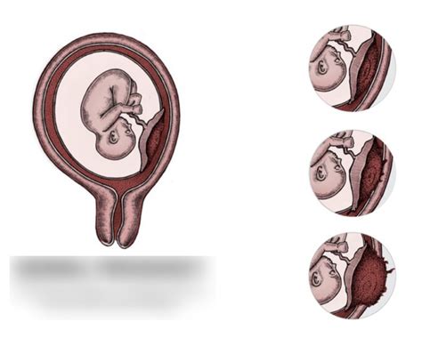 Label Abnormal Placental Attachment Diagram Quizlet