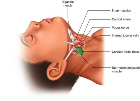 Excision Biopsy Of Lymph Node Aglow Ent Centre