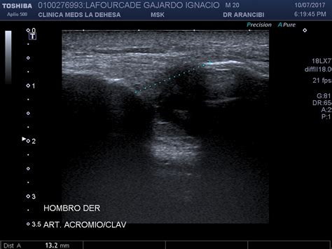 Luxación Acromio Clavicular Tipo Ii Iii De Rockwood Ecografía Deportiva