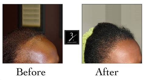 Female Hair Transplant Land Ziering Medical Get Appointment Now