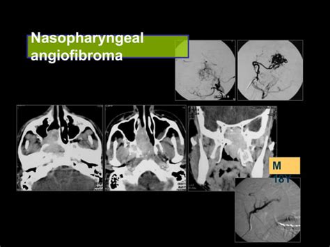All About Detaled Description Parapharyngeal Spaces Pptx