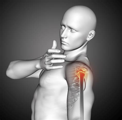 Luxación De Hombro Causas Síntomas Y Tratamiento Sportsalud Clínica