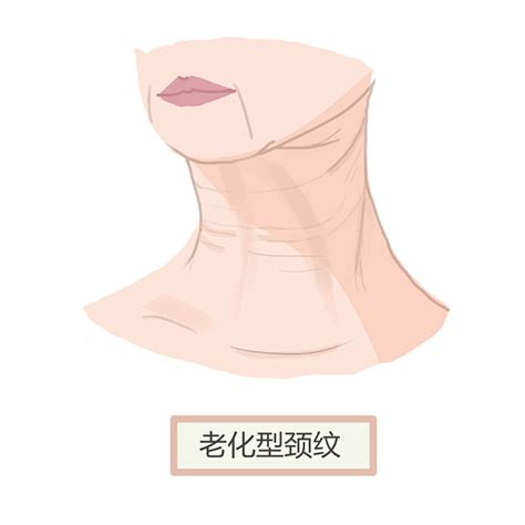 老化型颈纹 颈纹 颈部 去皱 去颈纹 嗨体去颈纹 肉毒素去皱 颈部抗衰 修复颈纹 紧致提升 干燥缺水 抚平颈纹 肉毒素去颈纹 伊肤泉去颈纹