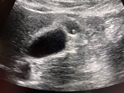 Hadeer Zaher On Linkedin Fundus Adenomyomatosis