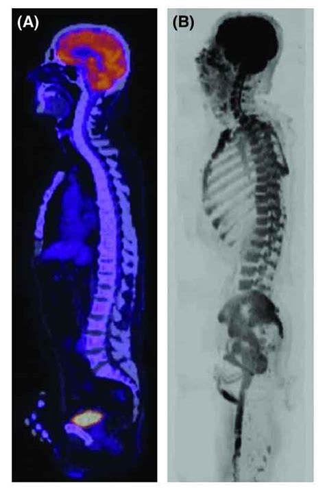 Sentimentale Suppongo Giunzione Rm Diffusion Whole Body Chiedere