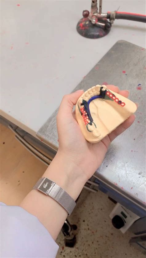 Metal Framework Waxing Procedures For Mandibular Rpd