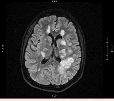 Mri T2 Weighted Image Showing Multiple Ring Enhancing Lesions