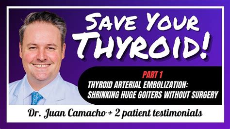 Thyroid Arterial Embolization In Sarasota Dr Juan Camacho