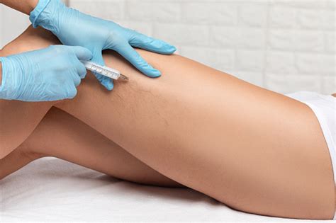 다리에 정맥류의 제거 텔란지크시아의 의료 검사 및 치료 플레베리즘 건강관리와 의술에 대한 스톡 사진 및 기타 이미지 건강