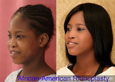 Patient 6319 Rhinoplasty African American Before And After Photos