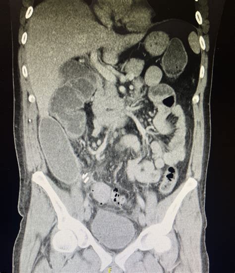 Higher Frcs On Twitter A 50 Year Old Man Had An Appendicectomy A Week Ago And Comes In At 10pm