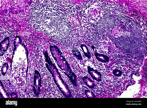 Crohns Disease Light Micrograph Of A Section Through The Intestine Of