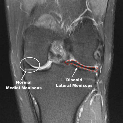 Discoid Meniscus What To Look For