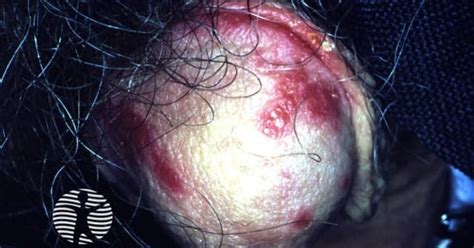 Genital Psoriasis Image