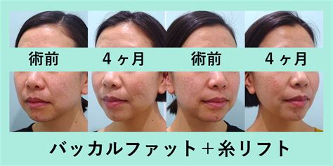 顔の重心を変える「小顔組み合わせ治療」 東京・銀座の美容外科クリニック｜wom Clinic Ginza