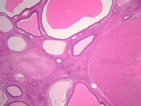 Corpus Albicans Histology