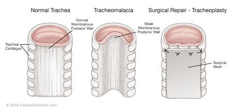 Tracheomalacia