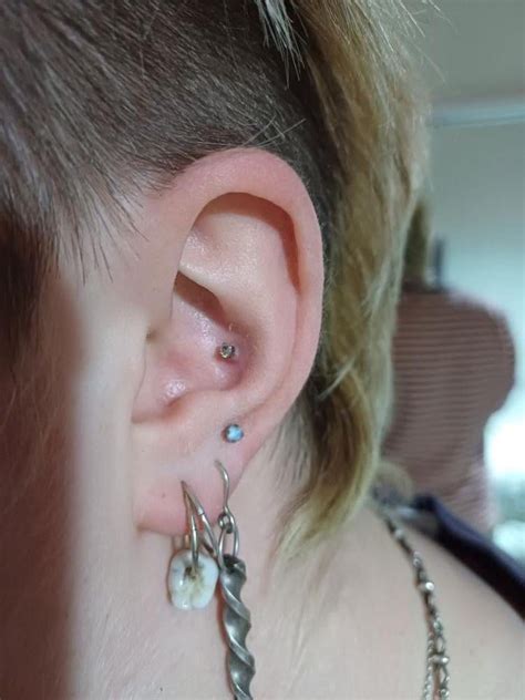 Bumps Tea Tree Oil Jaw Surgery Rpiercing