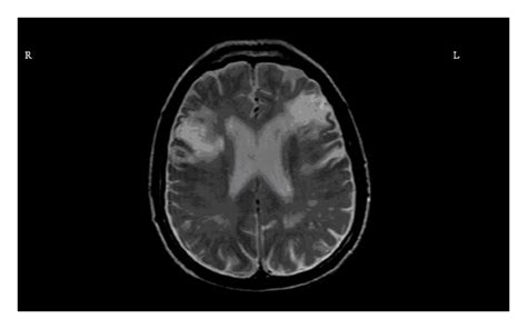 Ischemic Bilateral Opercular Syndrome Milanlioglu 2013 Case