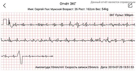 Обзор фитнес-браслета с ЭКГ и тонометром HerzBand Lite ECG